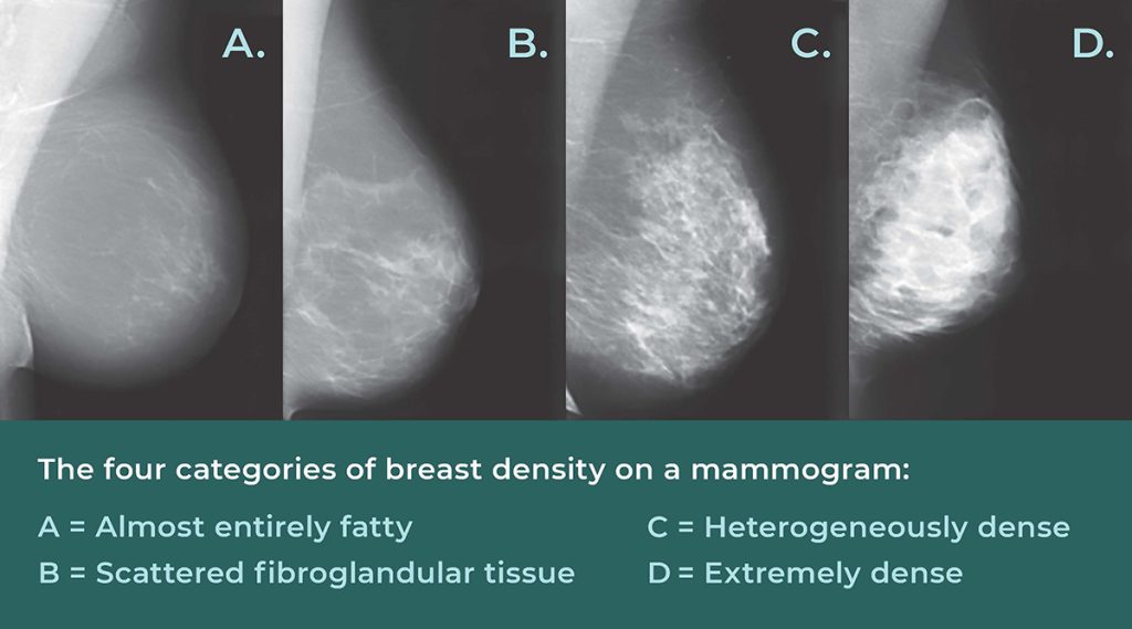 Breast Health: How do I know if I have dense breast tissue?