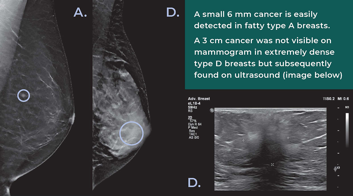 Breast Health: How do I know if I have dense breast tissue?